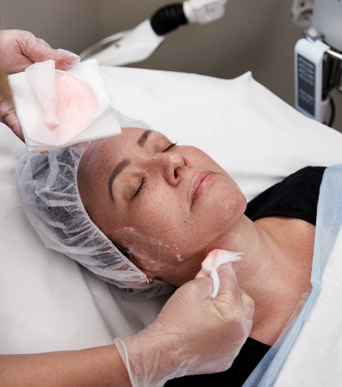 PDO Thread Lifts – Kate Somerville US